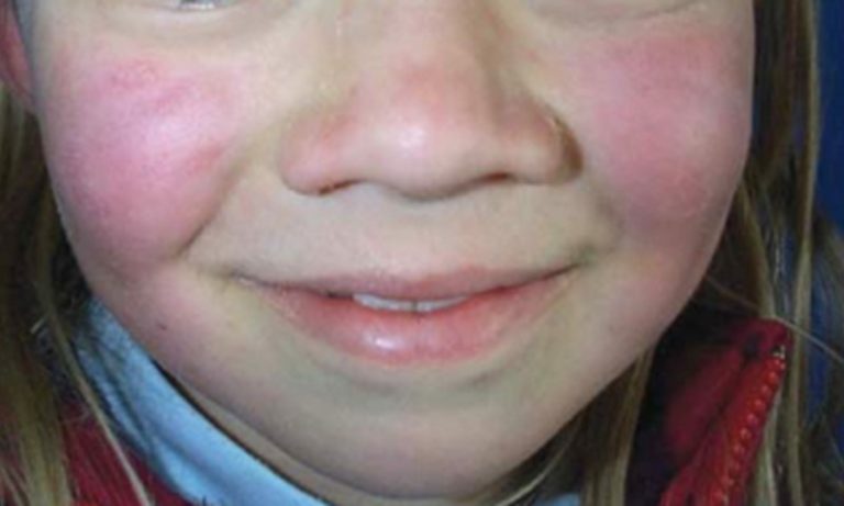 Slapped cheek syndrome | NHS inform