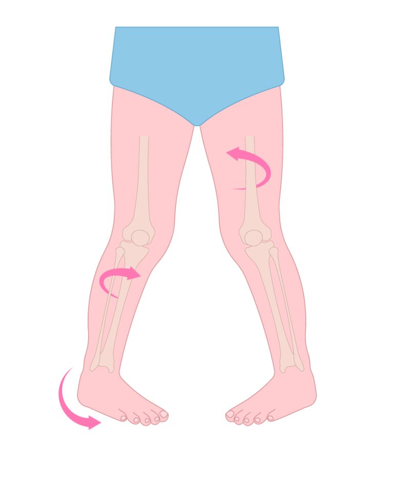 Intoeing in children and young people | NHS inform