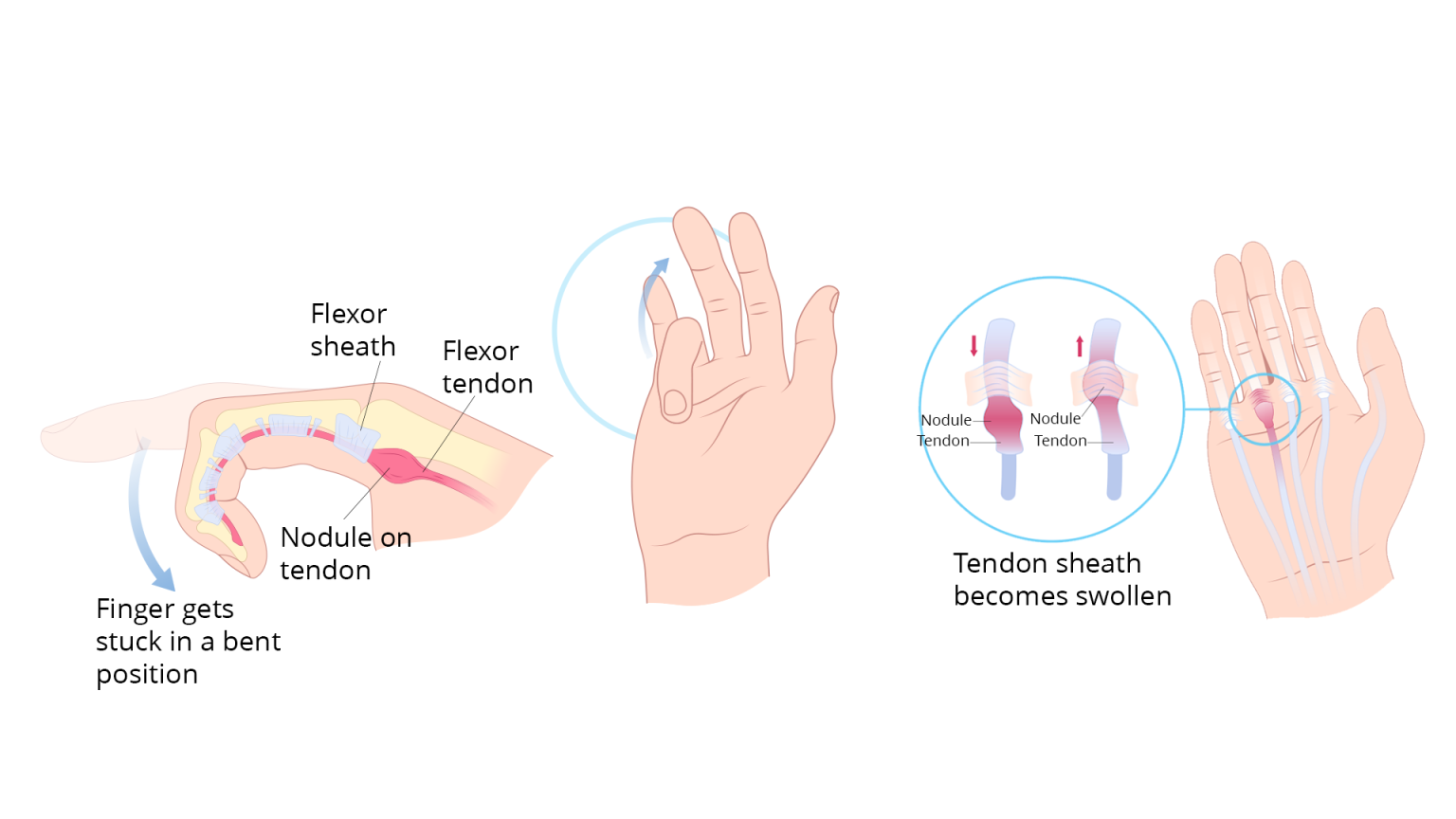 Trigger finger or trigger thumb in adults | NHS inform